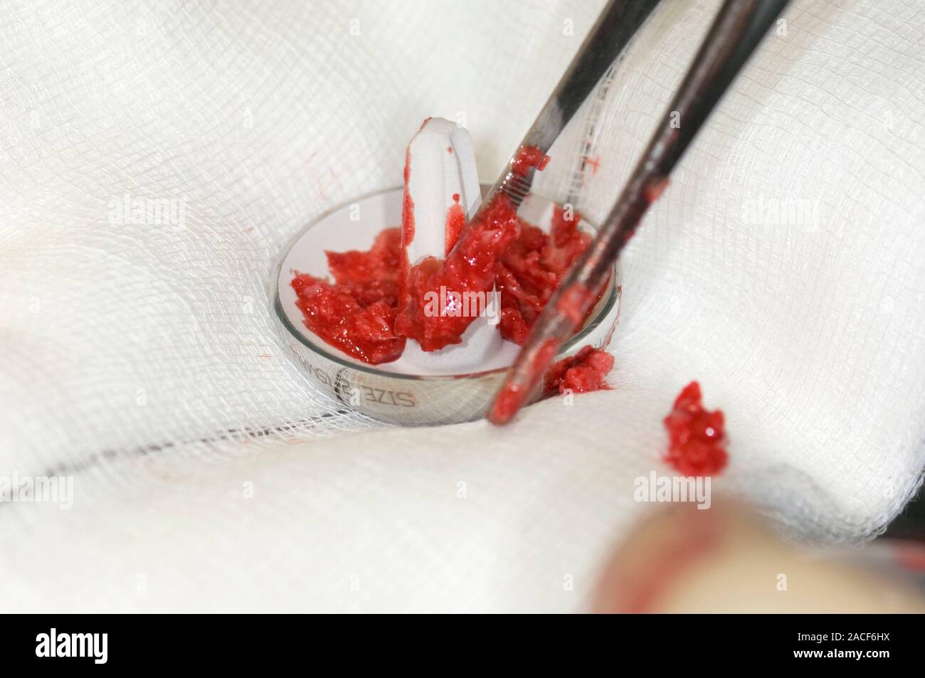 Shoulder joint re-surfacing surgery. Image 10 of 11. Close-up of the ...