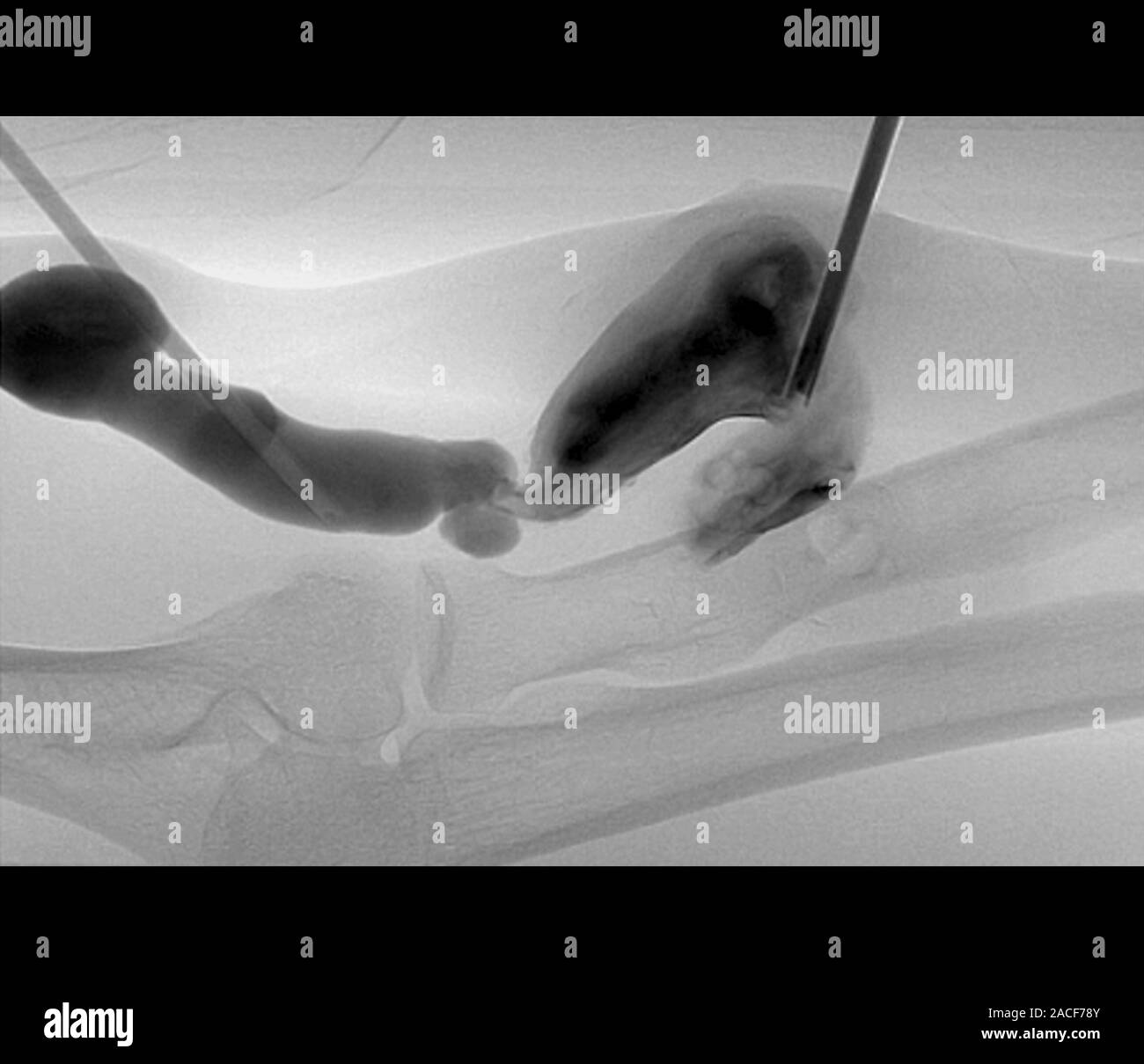 Blood clot in the arm. Angiogram of a blot clot (thrombus, dark) that ...
