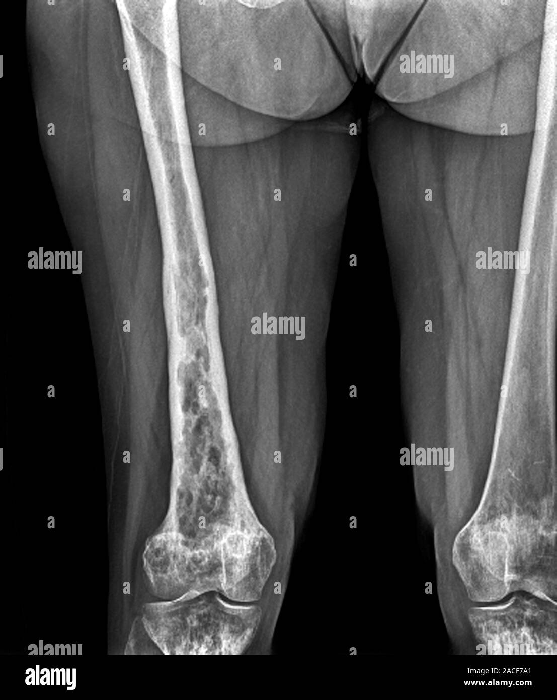 Bone disease. Frontal X-ray of the right thigh bone (femur) of a 60 ...