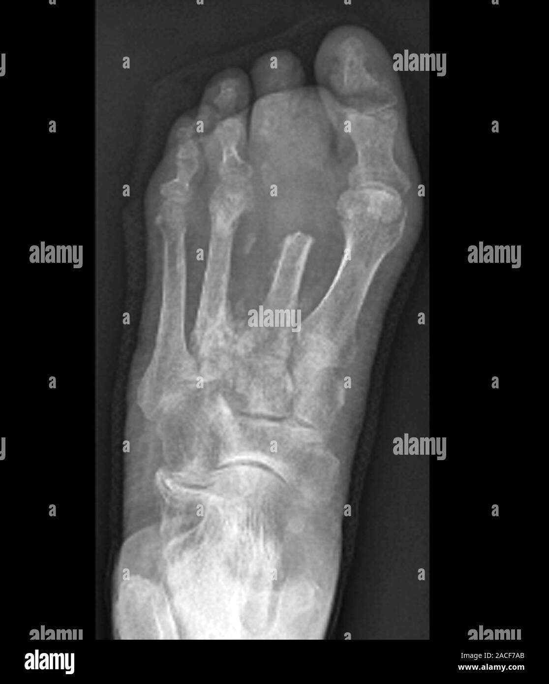 Bone infection. X-ray of the left foot of a 65 year old diabetic ...