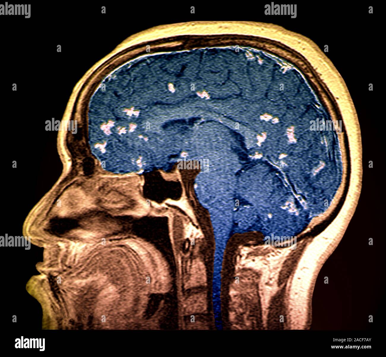 Diseased brain. Coloured magnetic resonance imaging (MRI) scan of an sagittal (side) section ...