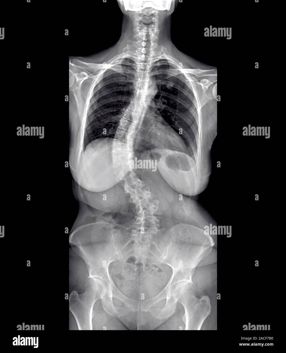 Scoliosis. Frontal X-ray of the torso of a 42 year old patient with ...