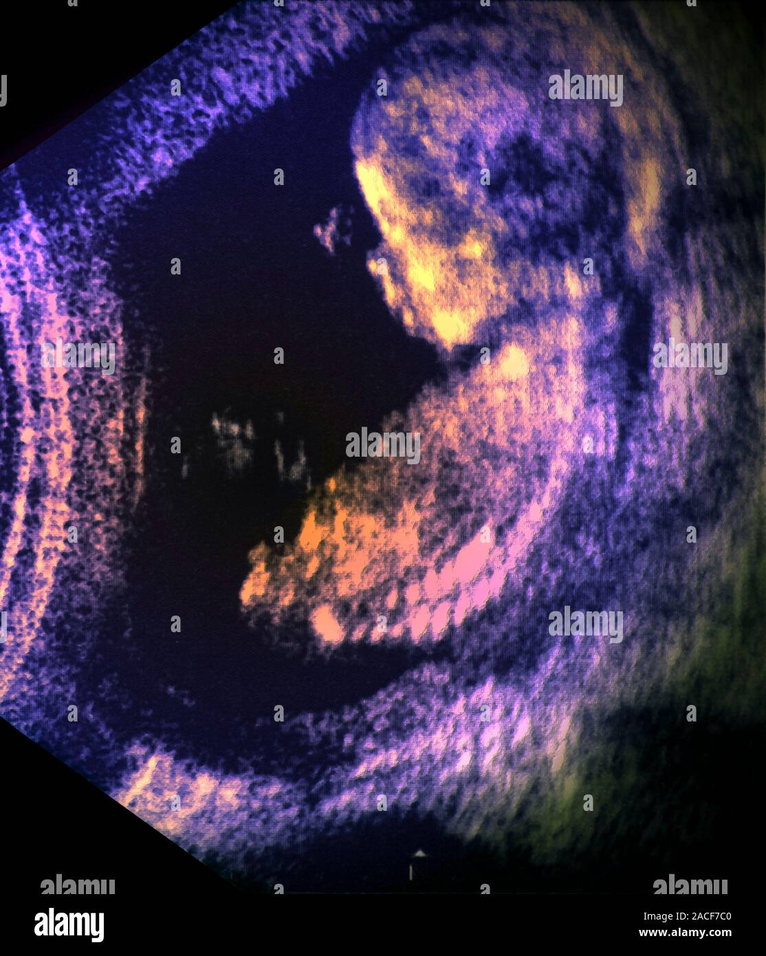 Foetus at 13 weeks, ultrasound scan Stock Photo - Alamy