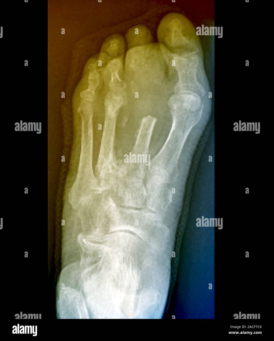 Bone infection. Coloured X-ray of the left foot of a 65 year old ...