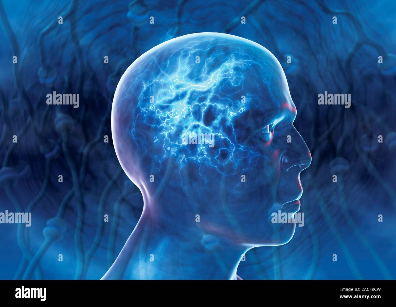 Epilepsy, conceptual computer artwork. Bolts of lightning inside a ...