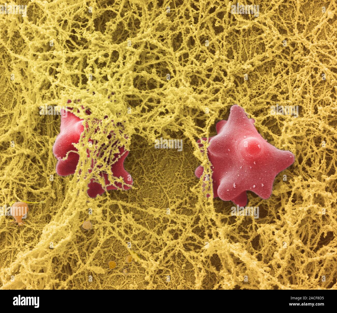 Blood clot, coloured scanning electron micrograph (SEM). Deformed red ...