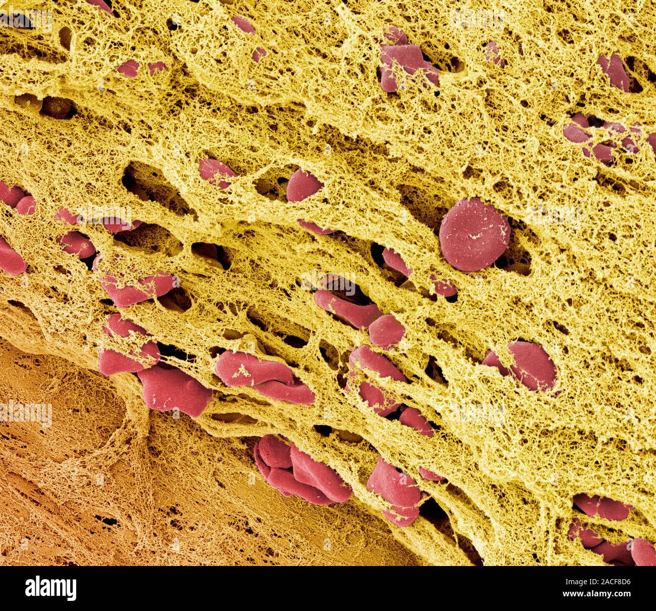 Blood clot, coloured scanning electron micrograph (SEM). Red blood ...