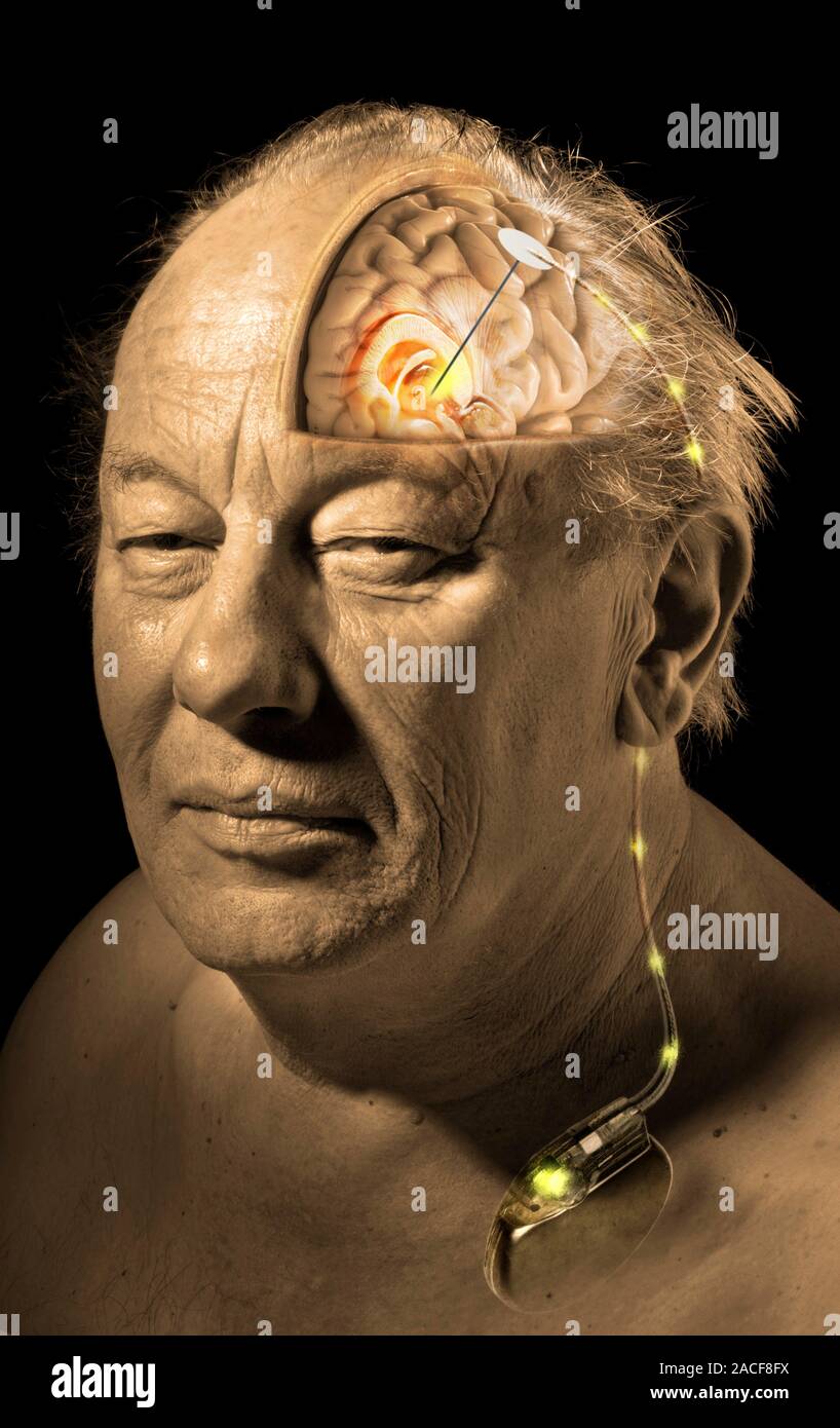 Deep brain stimulation (DBS), cutaway computer artwork. This ...