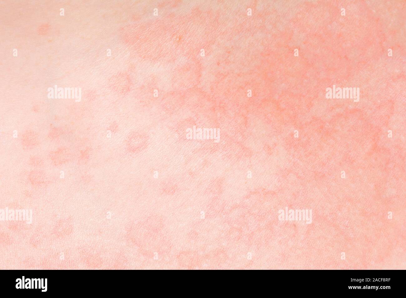 Urticaria rash (red patches) on a 23-year-old woman's skin. Urticaria ...