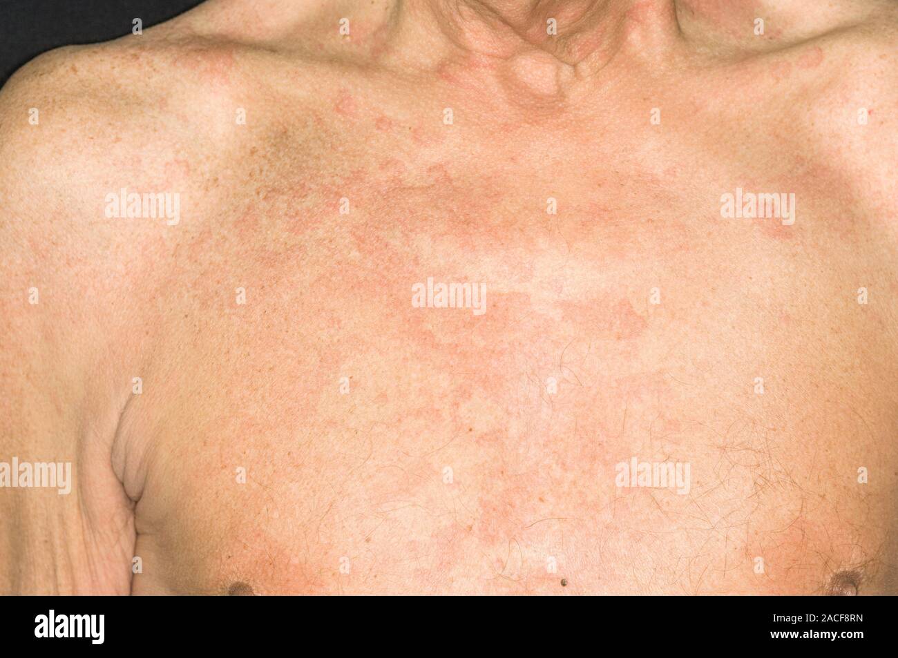 Urticaria rash (red patches) on a 77-year-old man's chest. Urticaria ...