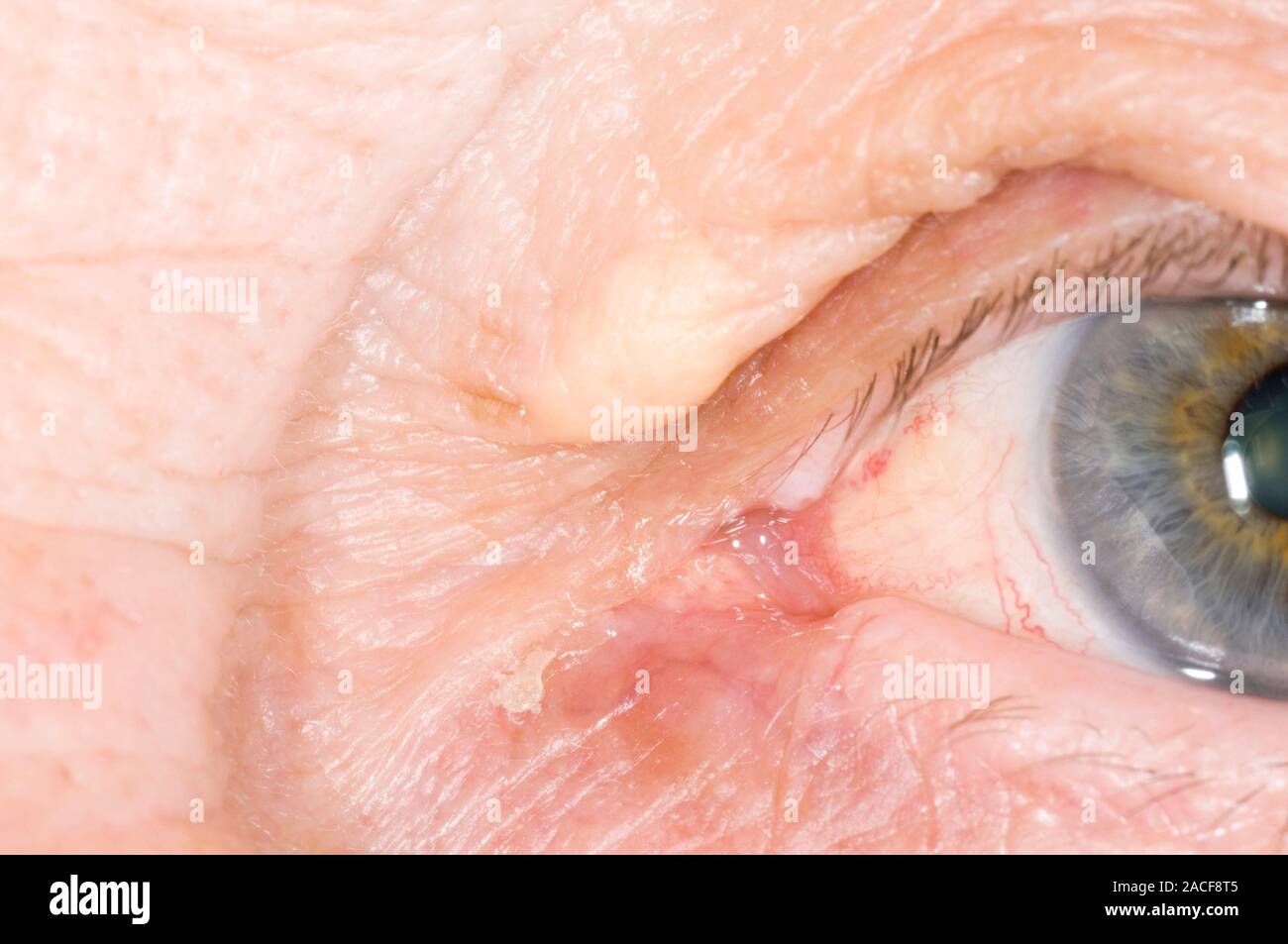 Xanthelasma. Fatty growth, called a xanthoma, seen on the upper eyelid ...