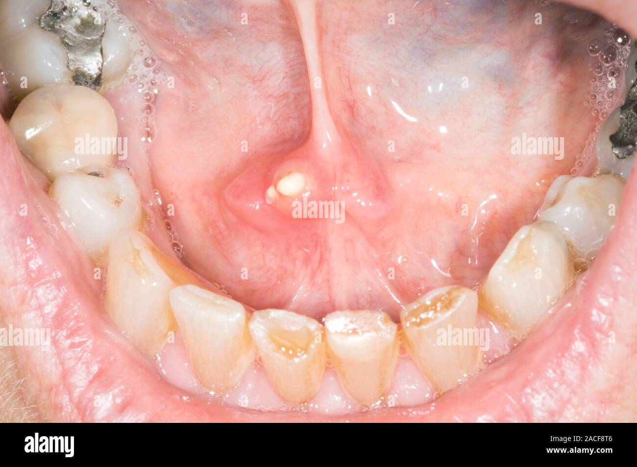 Salivary duct calculus (centre, white) in the submandibular salivary ...