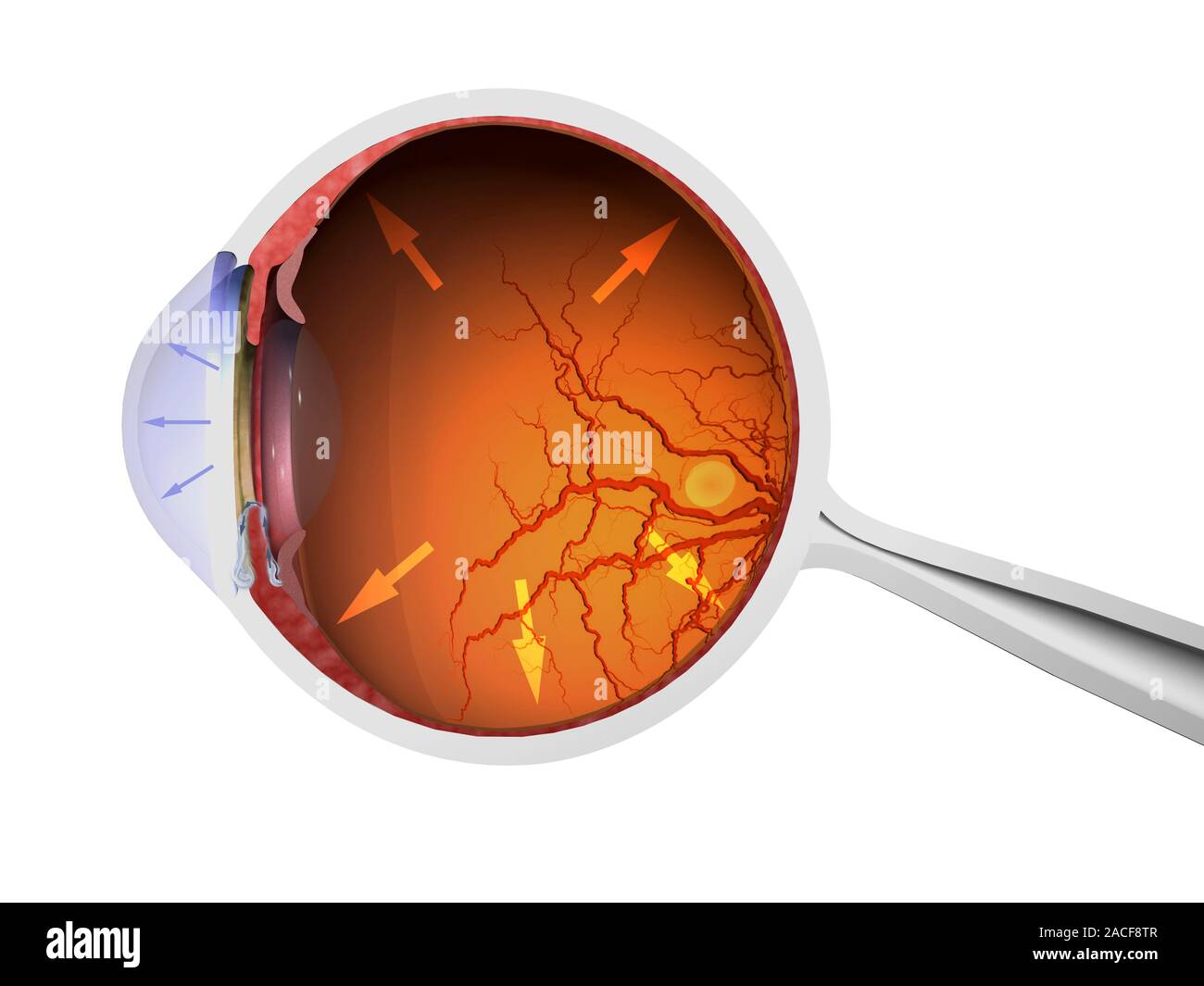 Glaucoma. Computer artwork of a cross-section through a human eye ...