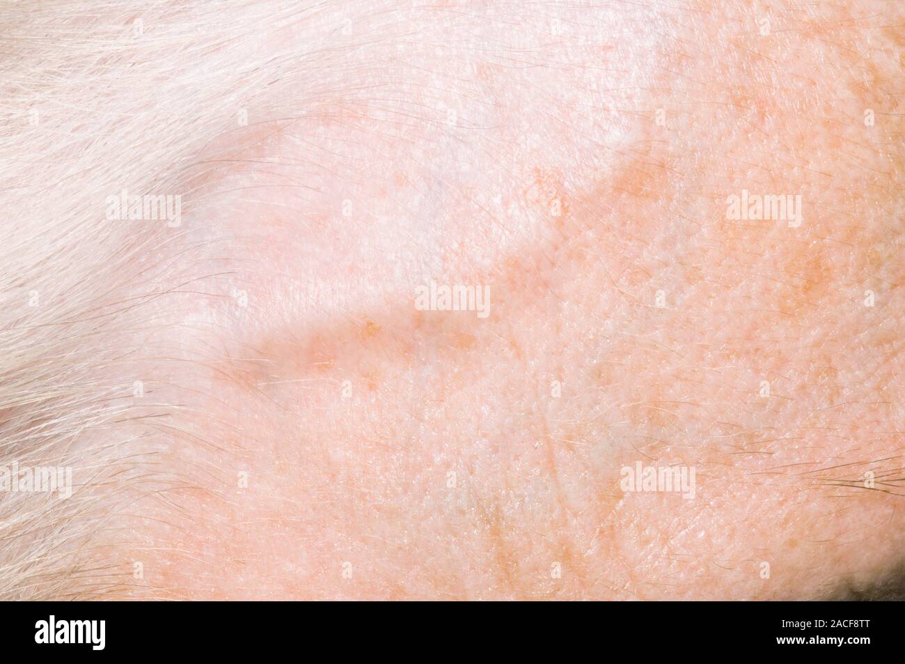 Temporal arteritis. Prominent artery with arteritis on the temple of a ...