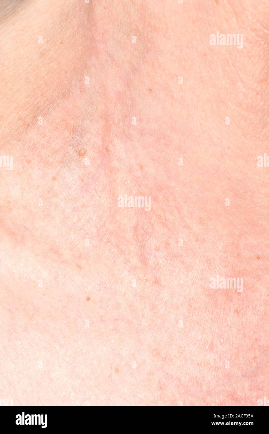 Shunt in the head of a patient with hydrocephalus, the abnormal ...