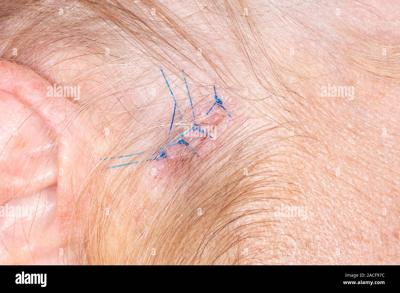 Stitches in a patient's temporal artery after biopsy surgery. This ...
