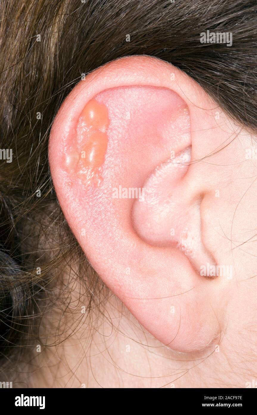 Herpes Simplex Lesion On The Pinna Of A Mans Ear Herpes Simplex Is A Common Viral Infection