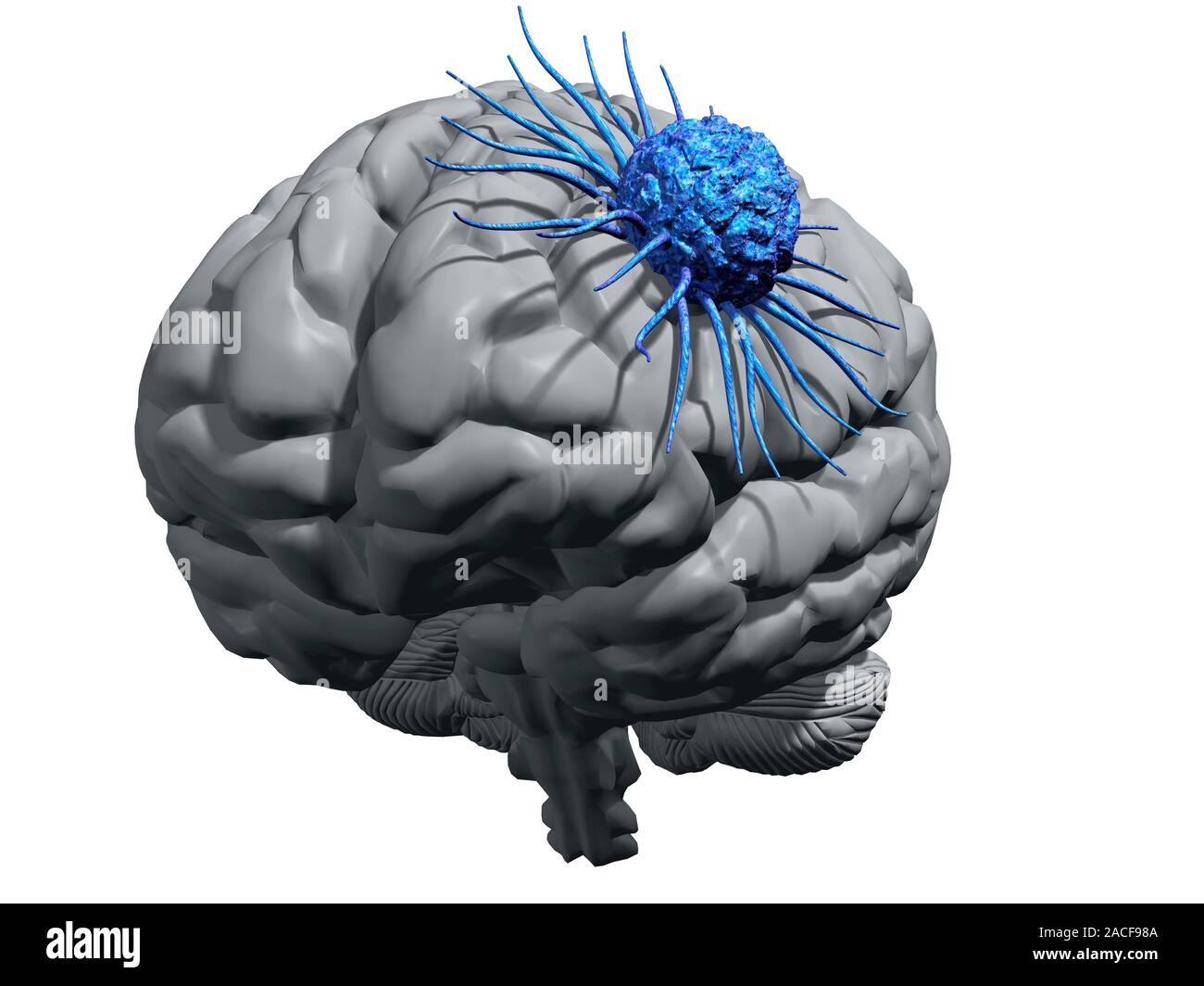 Brain cancer, conceptual computer artwork. Cancer cell on the left ...