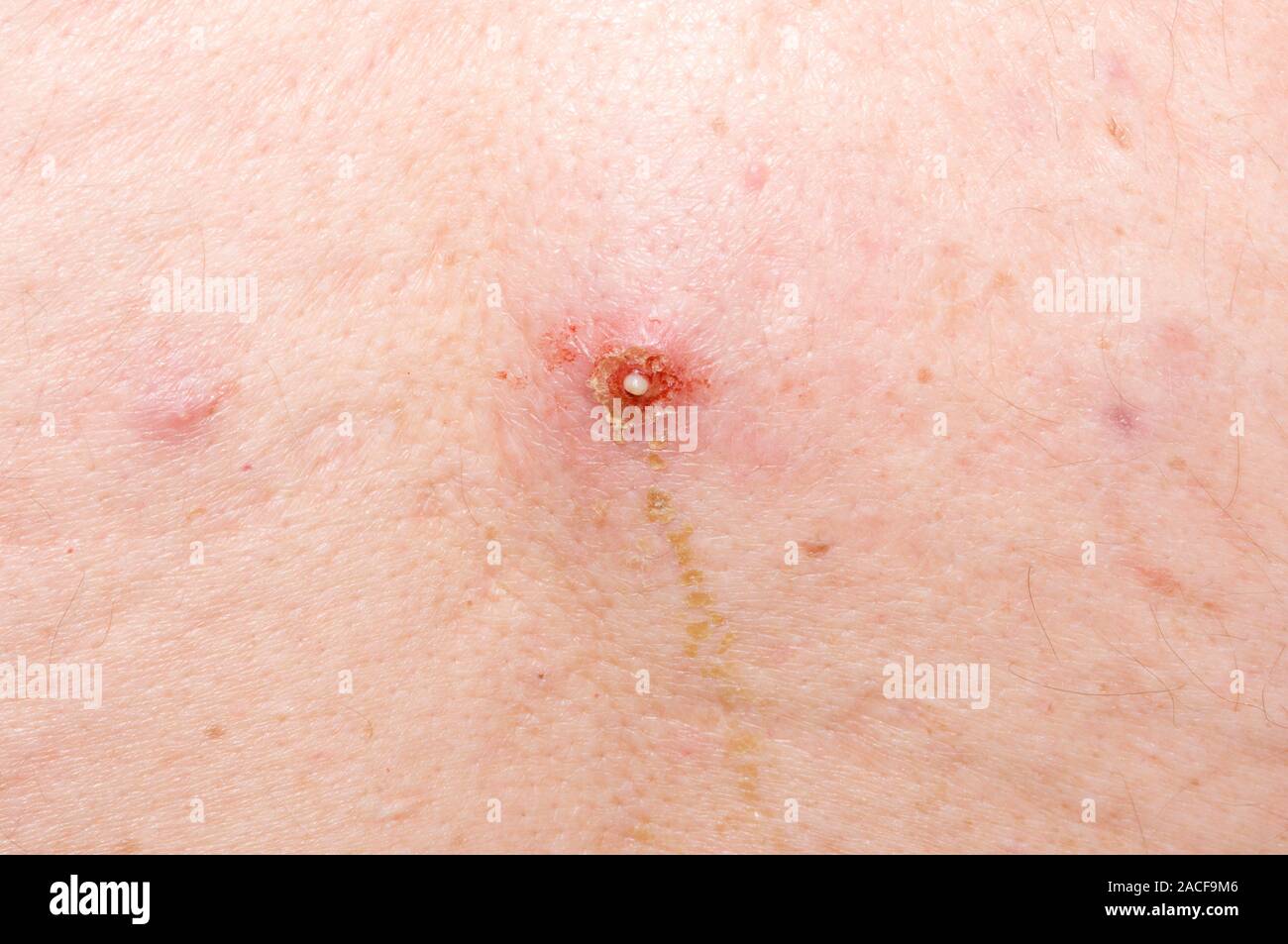 Infected Sebaceous Cyst Centre On The Back Of A 47 Year Old Man Image 2 Of 2 A Sebaceous