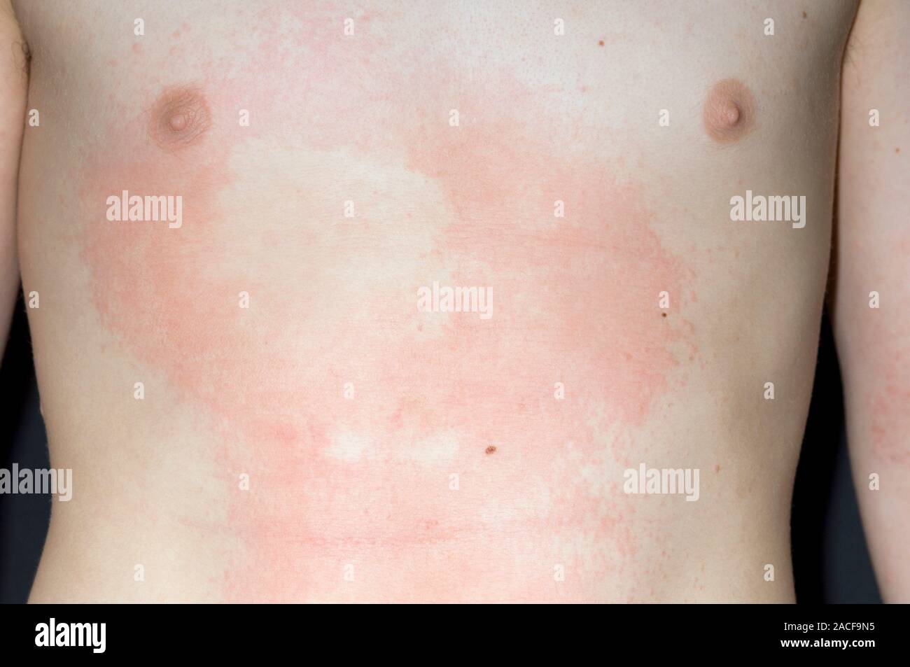 Urticaria rash (red patches) on a 14-year-old boy's chest. Urticaria ...