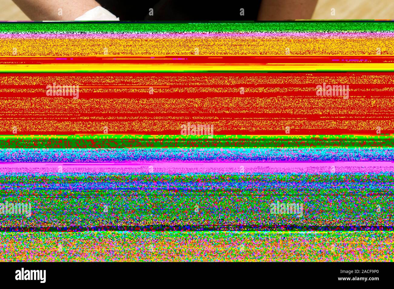 Surgical wounds infected with MRSA. Leg of a 19-year-old woman infected ...