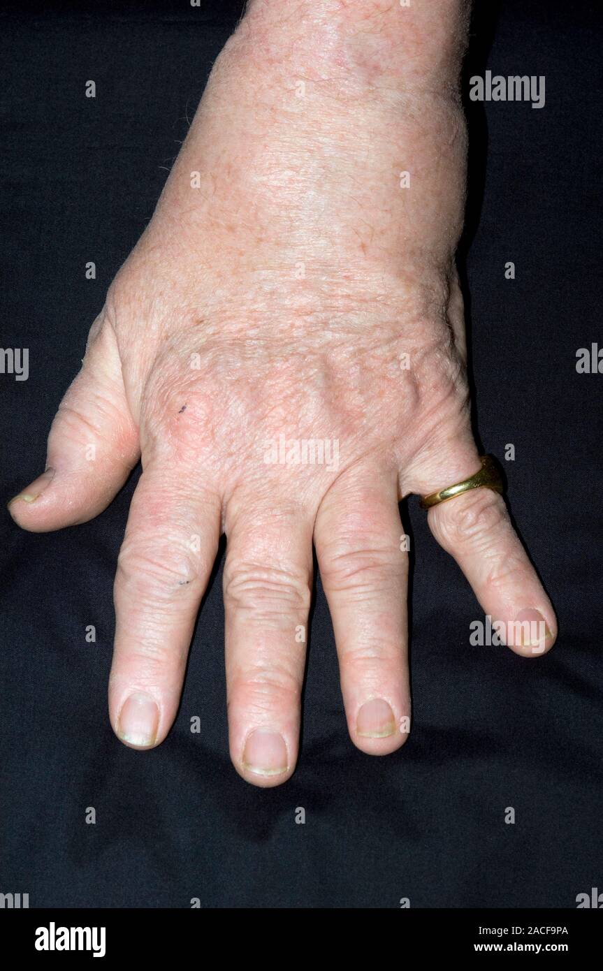 Psoriatic Arthritis Close Up Of The Hand Of A 61 Year Old Man Affected 1437