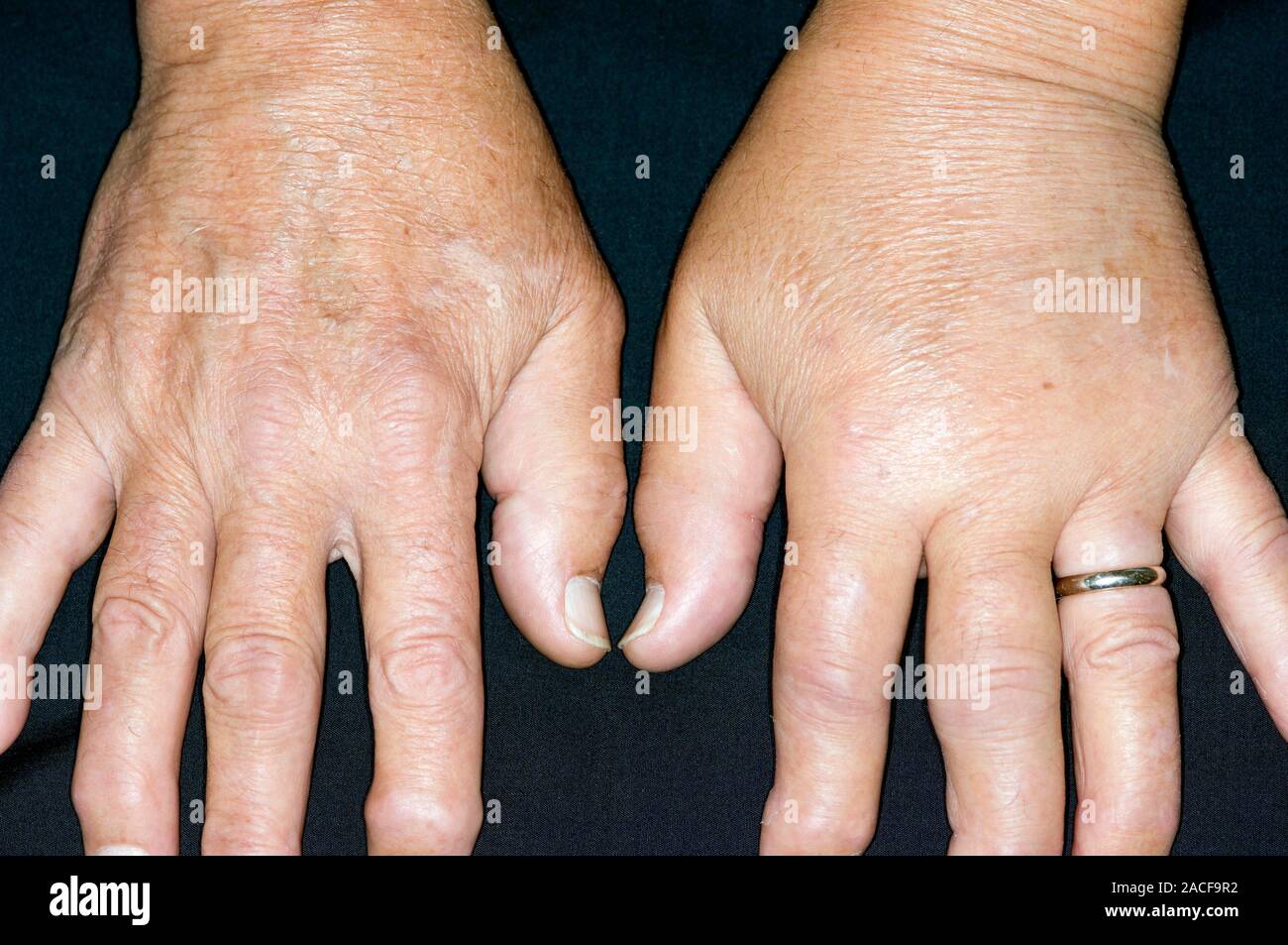 Gout. Swollen left hand (right) compared to the normal looking right ...