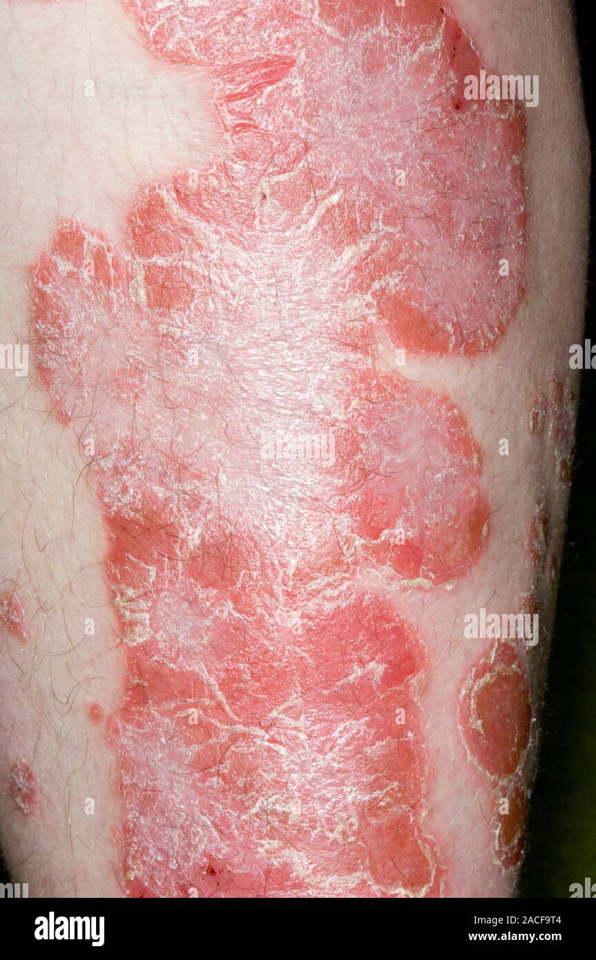 Plaque psoriasis on the limb of a 30-year-old woman. Psoriasis is a ...