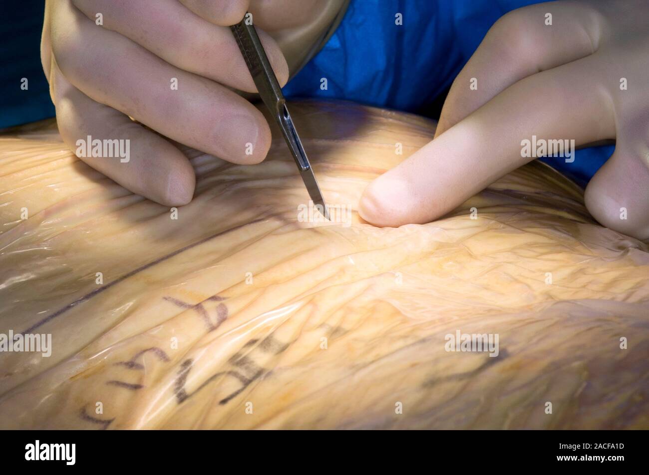 Spinal decompression surgery. Image 2 of 6. Surgeon preparing to make ...