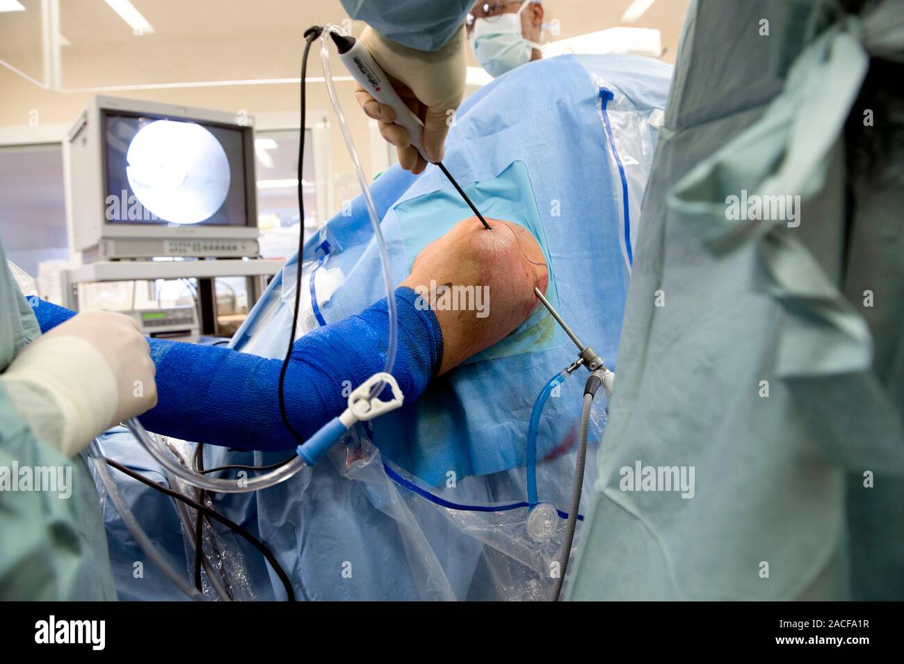 Shoulder arthroscopy. Image 2 of 4. Arthroscopic procedure being ...