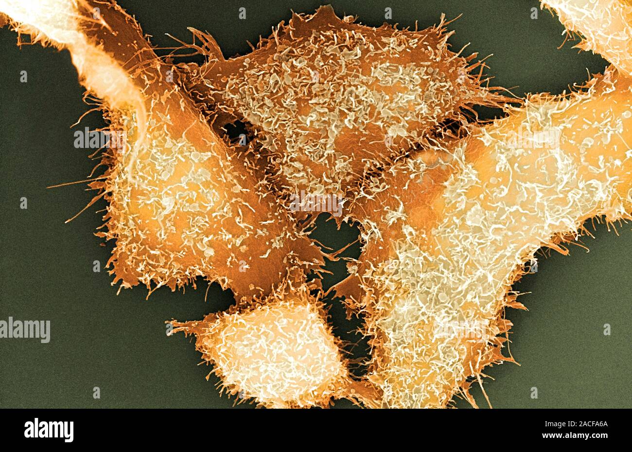Prostate cancer cells, coloured scanning electron micrograph (SEM). The ... Prostate cancer cells, coloured scanning electron micrograph (SEM). The ...