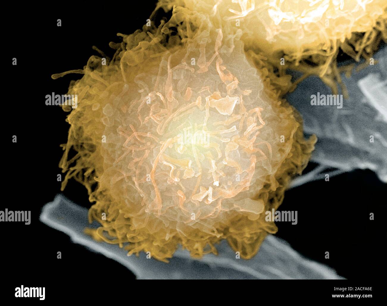 Prostate cancer cells, coloured scanning electron micrograph (SEM). The ...