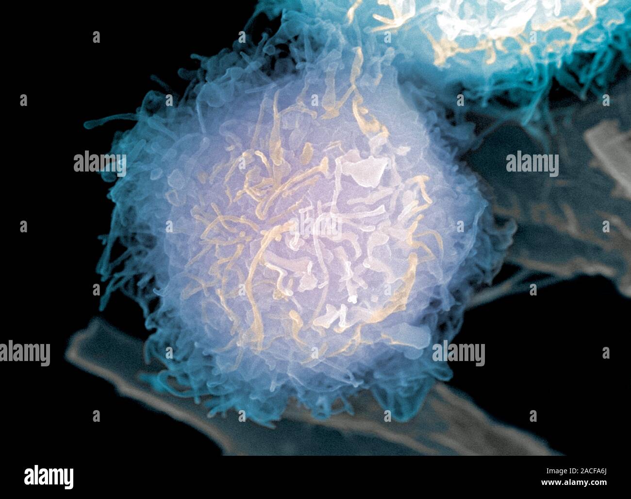 Prostate cancer cells, coloured scanning electron micrograph (SEM). The ...