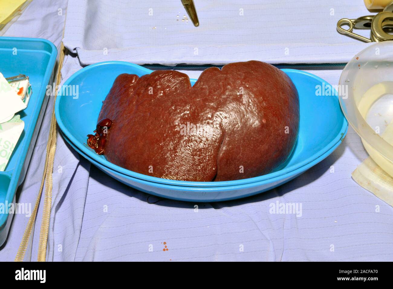 Spleen removal surgery. Image 9 of 9. Enlarged spleen that has been ...