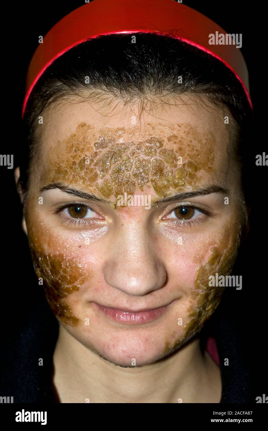 Acne scar treatment. Newly formed crusts on the forehead and, cheeks ...