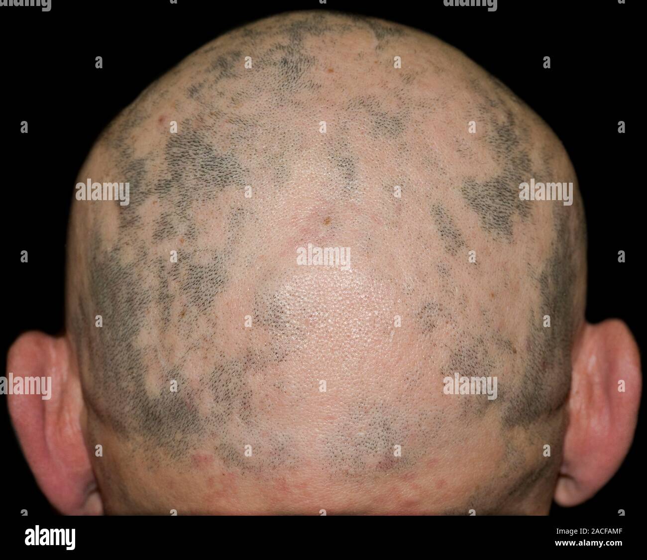 Hair loss disorder. Multiple patches of alopecia areata on the scalp of ...
