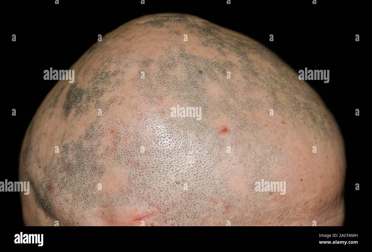 Hair loss disorder. Multiple patches of alopecia areata on the scalp of ...