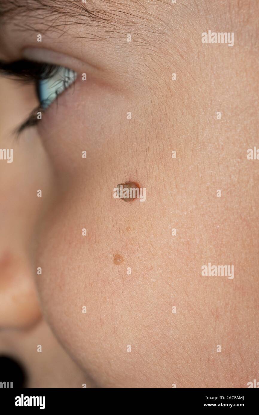 Wart (verruca vulgaris) on the upper cheek of a 7-year-old girl. Warts ...