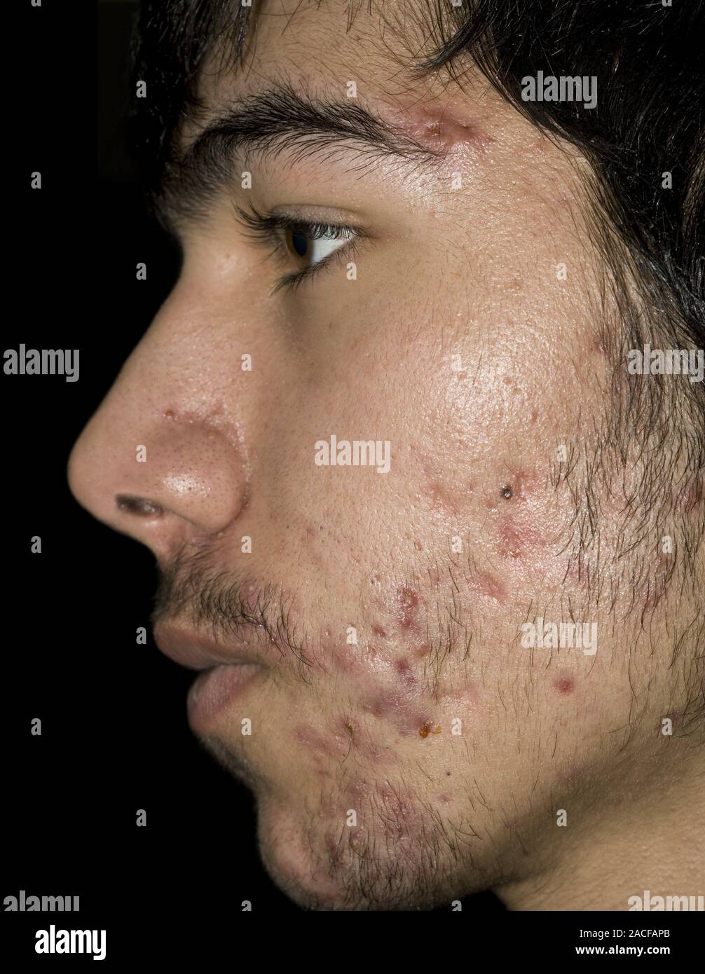 Acne. Cheeks of a man with acne and severe scarring from cystic pimples ...