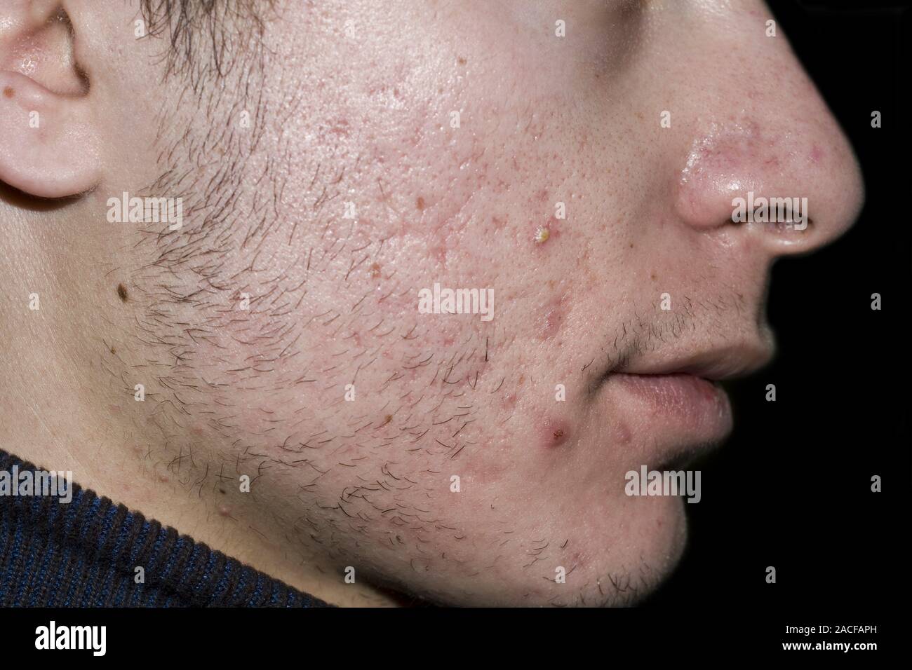Acne. Cheeks of a man with acne and severe scarring from cystic pimples ...