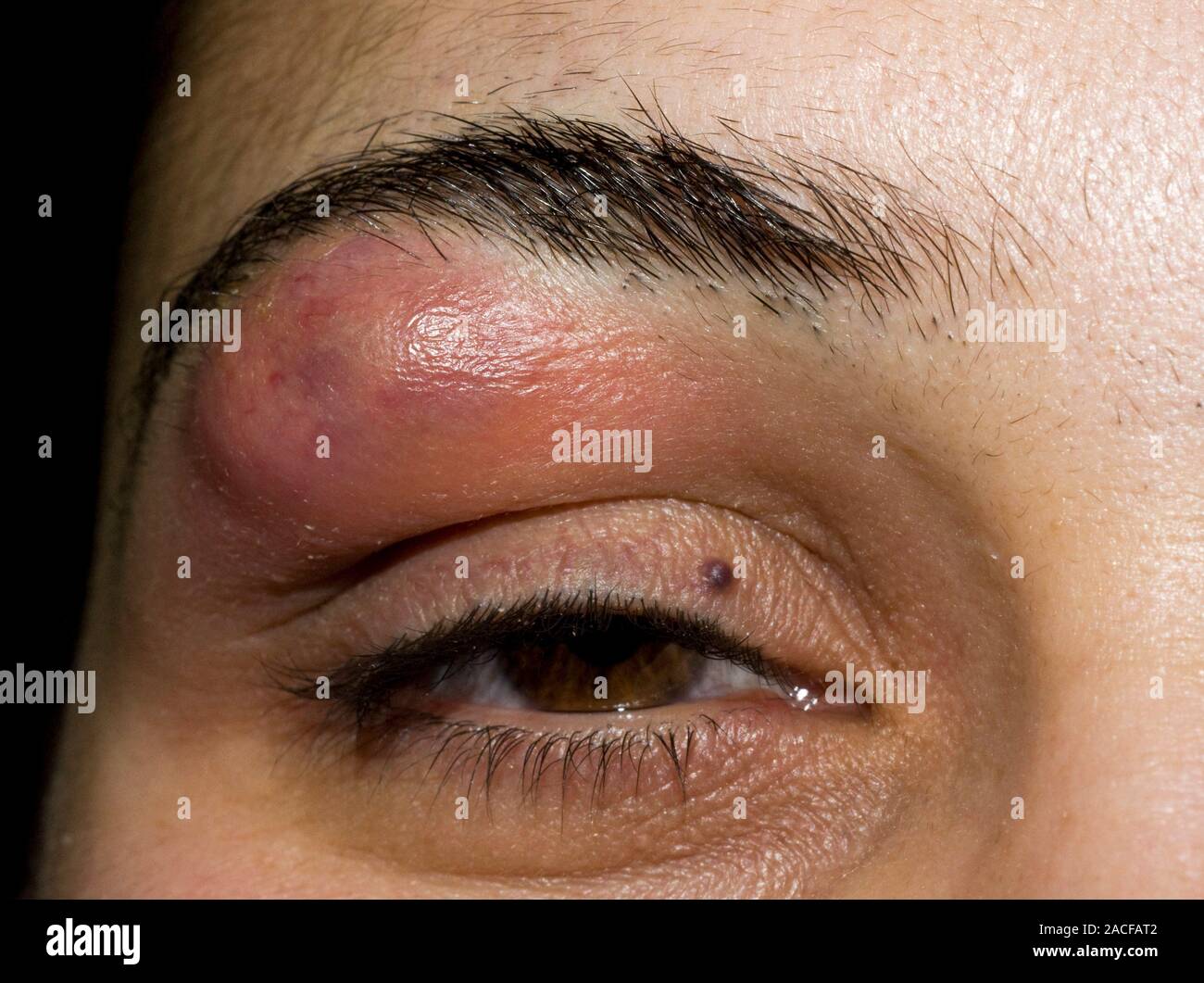 Boil on the brow. A red, inflamed and pus-filled boil (furuncle ...