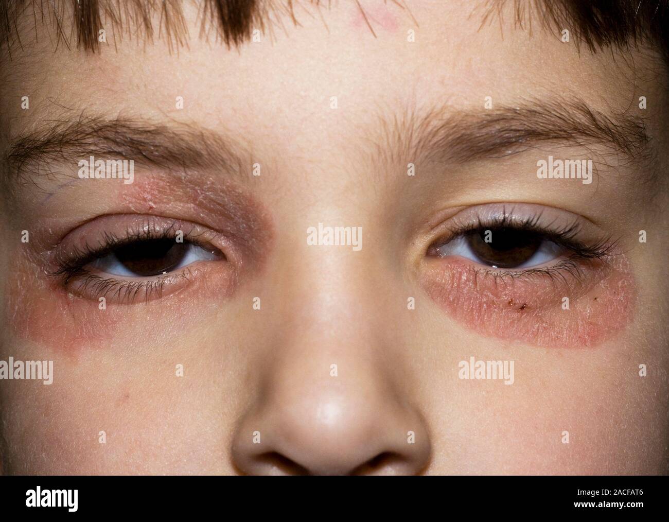 Psoriasis (red patches) around 6-year-old boy's eyes. Psoriasis is a ...