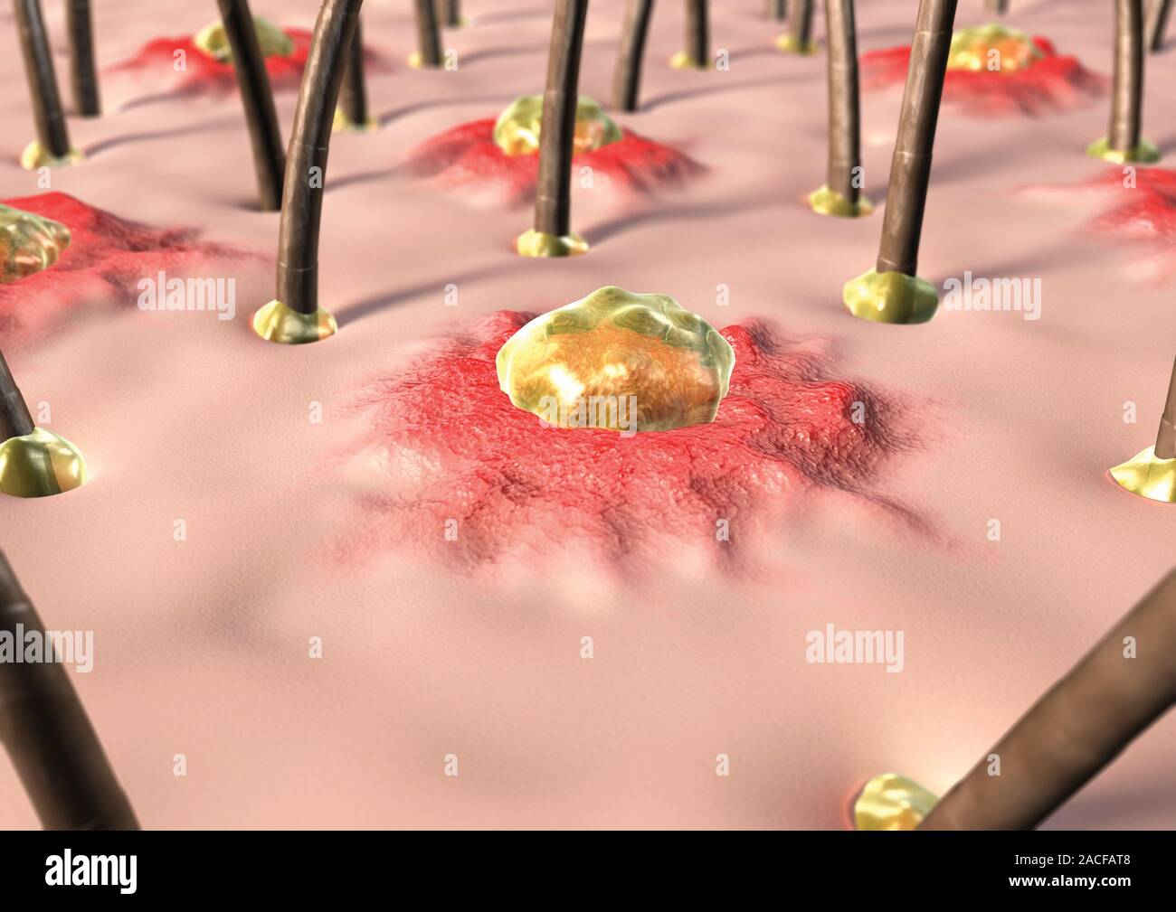 Blocked pore in acne, computer artwork. Sweat pore (centre) that has ...