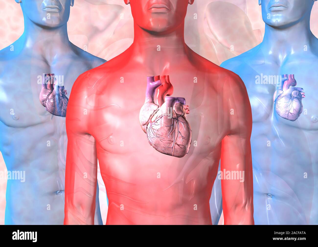 Heart failure, computer artwork. The figure at centre (red) has an ...