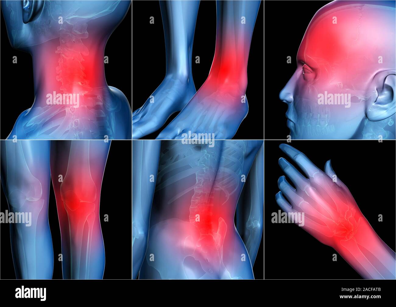 Body pain. Computer artwork showing pain (represented by the red areas ...