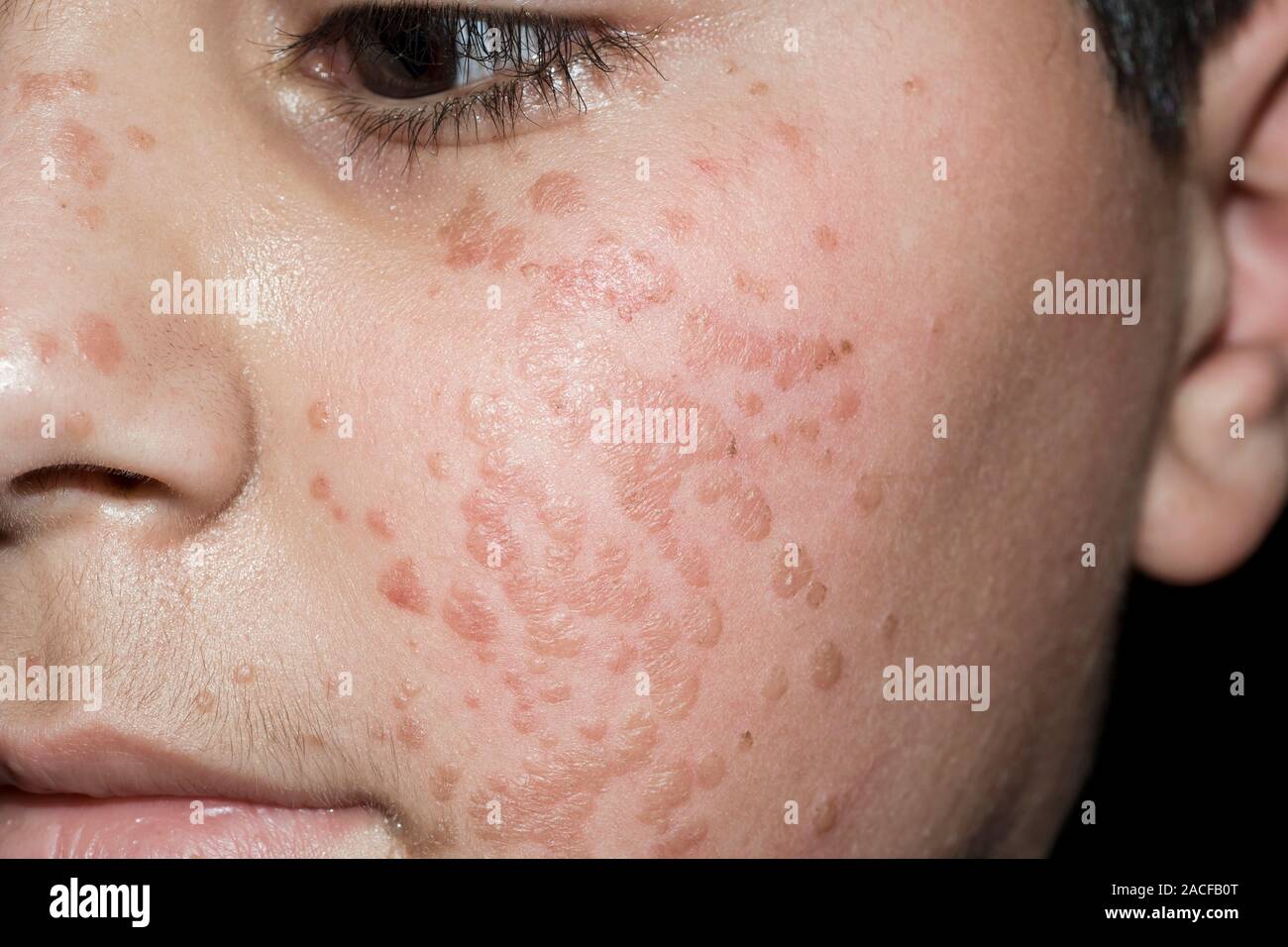 Flat warts (verruca plana) on the face of a 9-year-old boy. Warts are ...