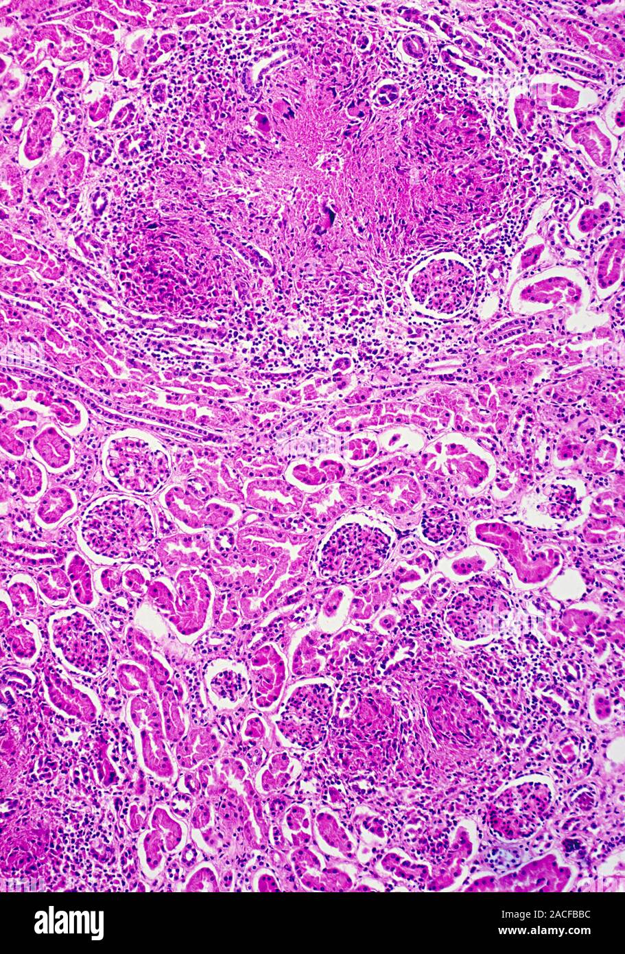 Renal tuberculosis. Light micrograph of tissue from the cortex of a ...
