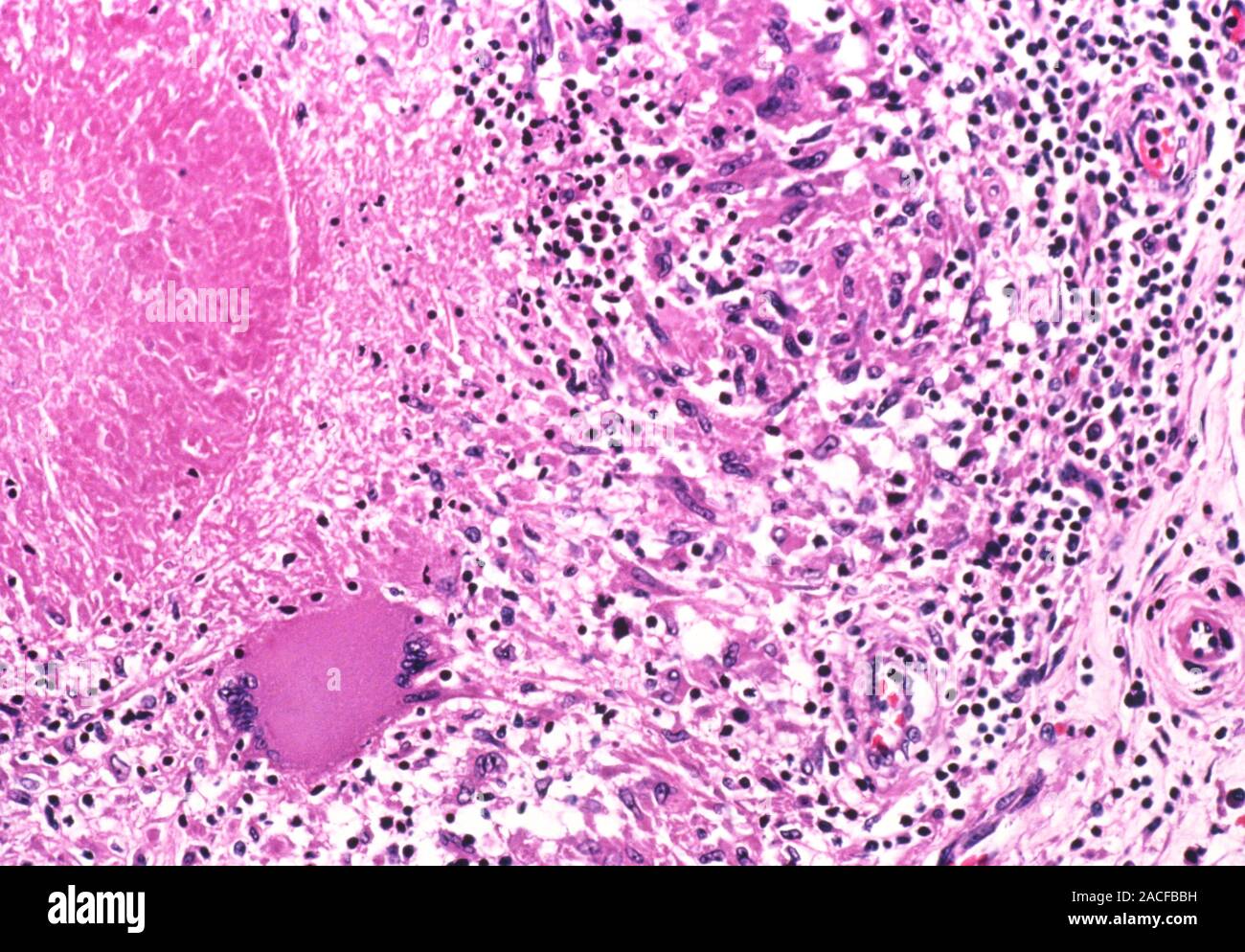 Pulmonary tuberculosis. Light micrograph of tissue from a lung in a ...