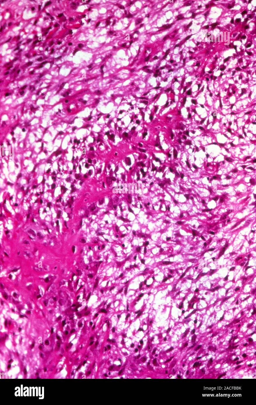 Bone repair. Light micrograph of bone tissue healing. Bone cells called ...