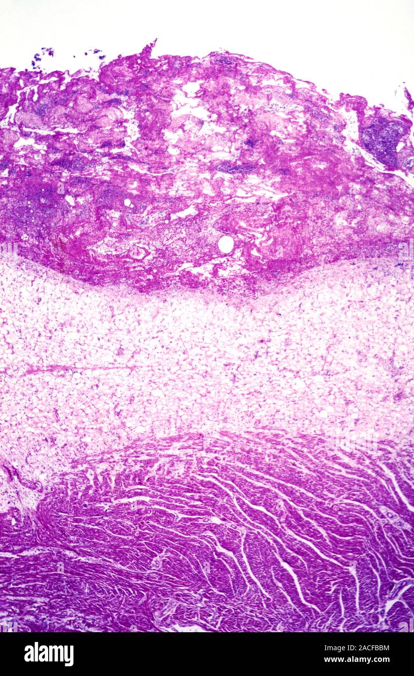 Acute pericarditis. Light micrograph of tissue from a heart in a case ...